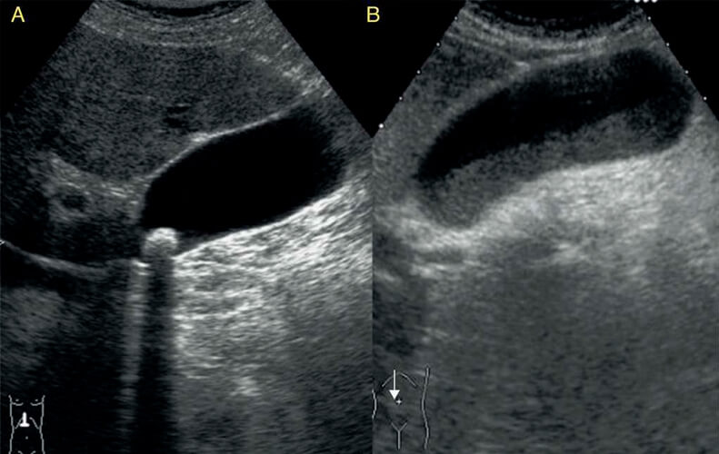 Colelitiasis - Especialista en Laparoscopía y Cirugía Robótica - Dr ...
